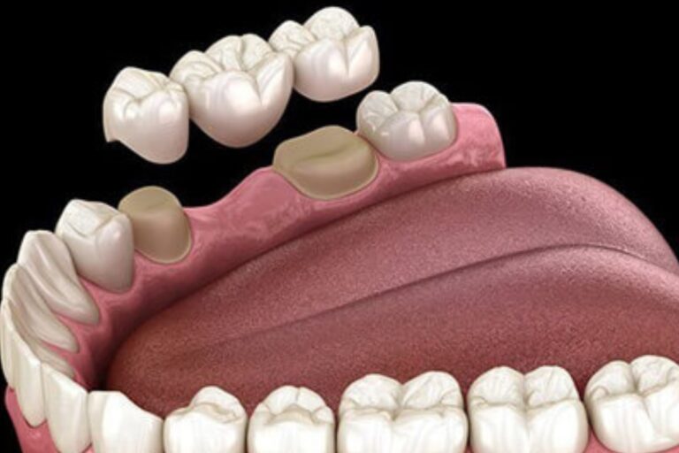 Why Dentists Recommend Bridges for Replacing Missing Teeth