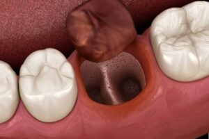 How Dentists Treat Dry Socket: Pain Relief & Healing